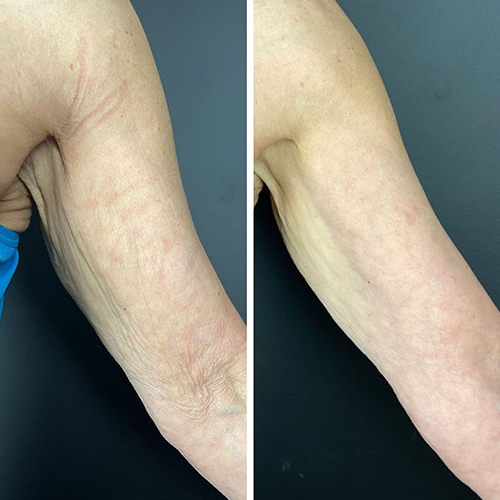 Renewal Peels – Kelly Reese